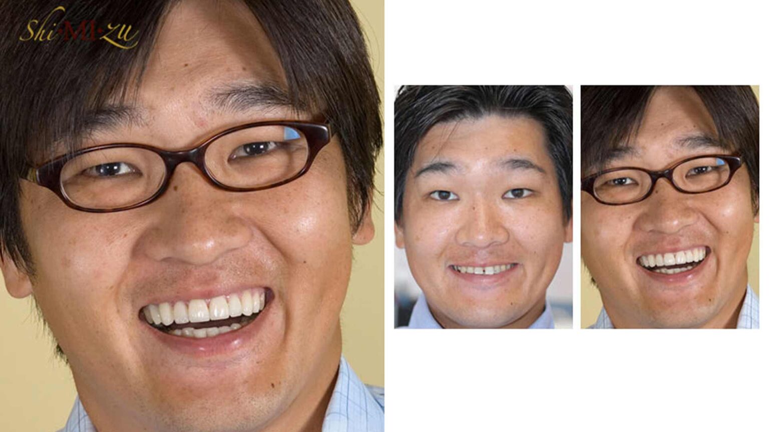 How to fix flared teeth after braces | Outward slanted teeth repair