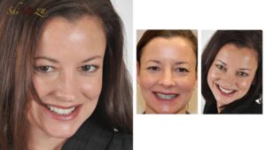 How to Lengthen Short Teeth with Dentistry