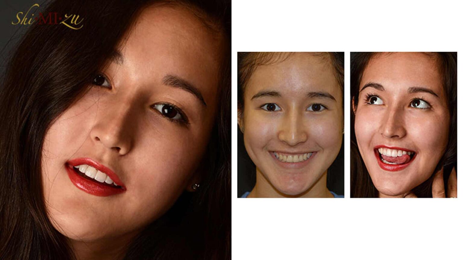 How to fix small teeth | Making small anterior teeth look larger