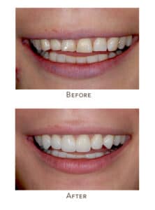 How to fix different sized teeth - Treat Uneven teeth