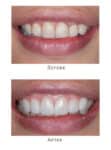 Black line(s) visible between the tooth and the gum line