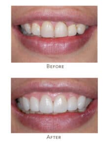 Black line(s) visible between the tooth and the gum line