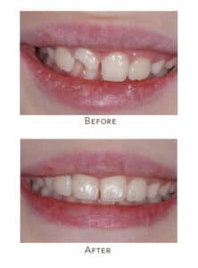 What to Do When Your Child Breaks a Tooth